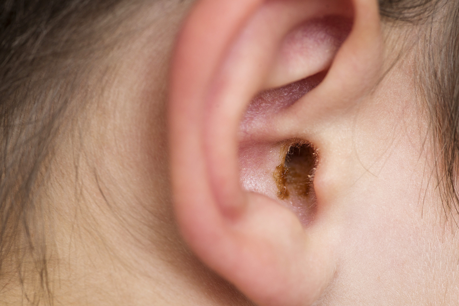 Laxative Helps Remove Earwax The People s Pharmacy